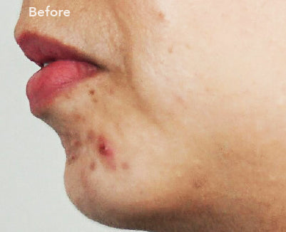 Here’s How You Can Manage Acne in Menopause – Riversol