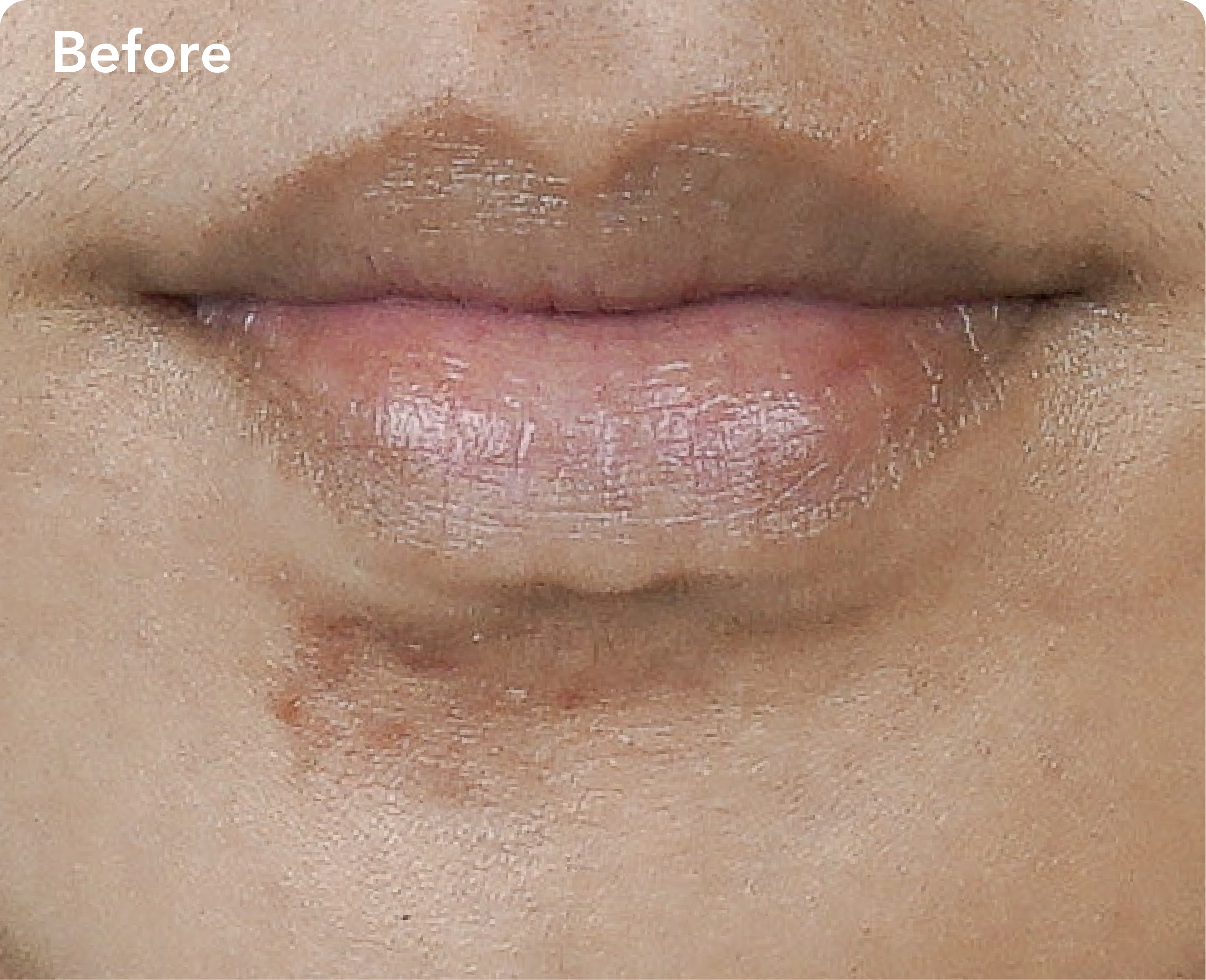 Comprehensive Acne Treatment - Acne treatment, blackhead treatment ...