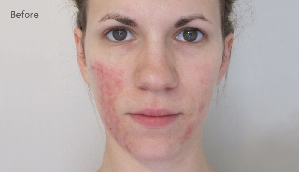 Redness Control Trio and Peel | Riversol Derm Developed