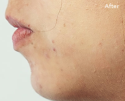 Here’s How You Can Manage Acne in Menopause – Riversol