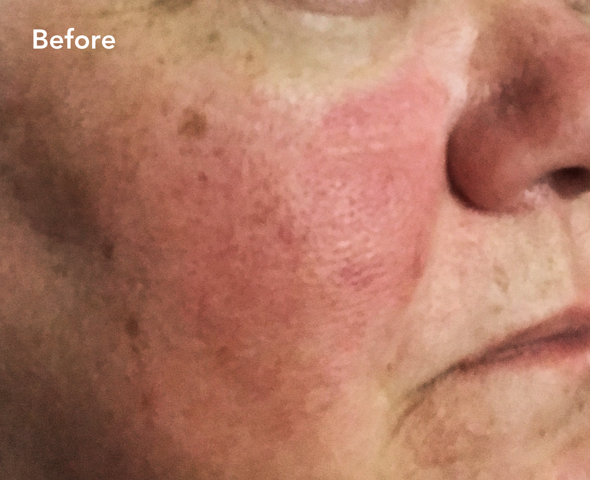 Redness Calming Face Mask with Beta-Thujaplicin, Niacinamide and ...